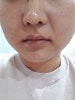 입술 색소침착 레이저치료 후기 D2 네이버 블로그